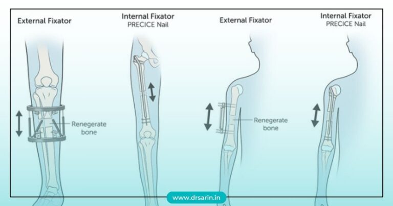 What types of devices are used for limb lengthening? - Dr. Sarin